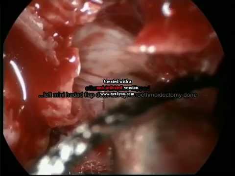 endoscopic endonasal approach for planum + cribriform plate meningioma