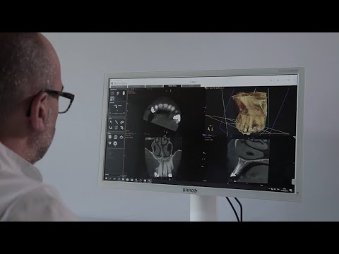 CS 9600 CBCT System – CS MAR with unique live comparison tool