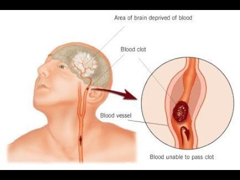 Stroke: Definition, Types, Causes, Signs and Symptoms, Investigation and Management