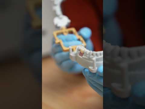 Encode Screw Retained Implant Crown