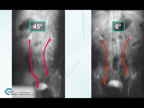 New AI Tool for Ureter Reconstruction from Fluoroscopic Images by RSIP Vision