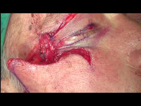 Triple-flaps for lateral canthus skin defect