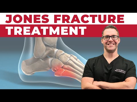 Jones Fracture Healing Time- The Complete Treatment Guide!