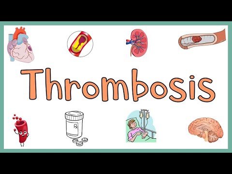 Thrombosis : Definition, Causes, Types, Morphology, Fate of a Thrombus & Clinical manifestations