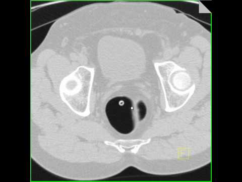 CASE1A.avi