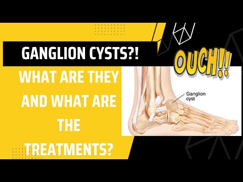 Ganglion cysts, mucoid cysts, OH MY!
