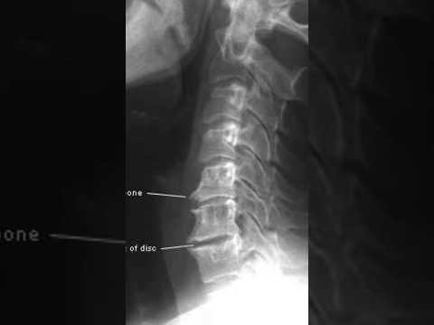 Calcification means long term inflammation #inflammation #arthritis #heartdisease #thyroid