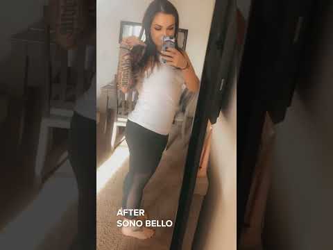 Mommy Makeover Review from Sono Bello | TriSculpt & AbEX Review