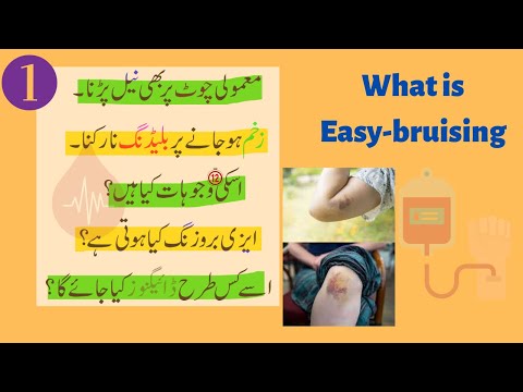 Easy Bruising | 12 causes of Easy bruising | bar bar neel ku prrty hn? | Urdu | Hindi | рд╣рд┐рдиреНрджреА |