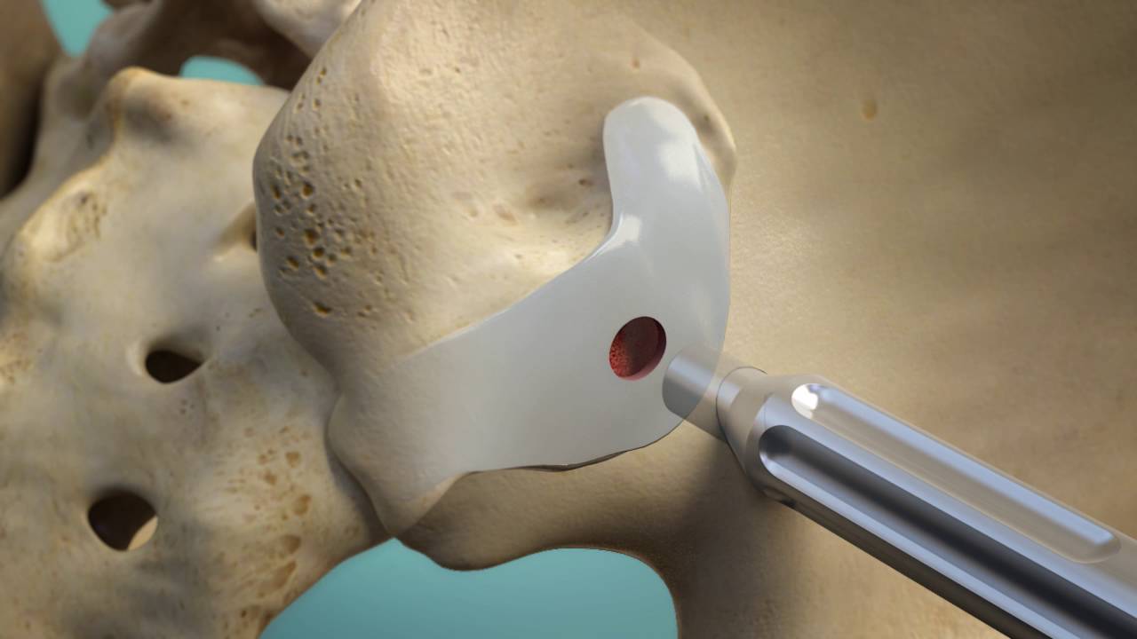 SImmetry Sacroiliac Fusion Animation