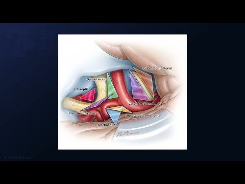 Clipping of Multiple Aneurysms: Contralateral ICA Terminus and Ipsilateral MCA Bifurcation
