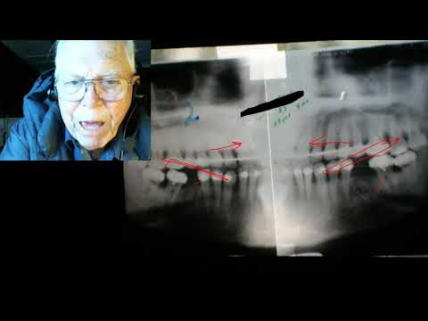 A special Class 3 Case- Non Surgical and lots to learn in this one!