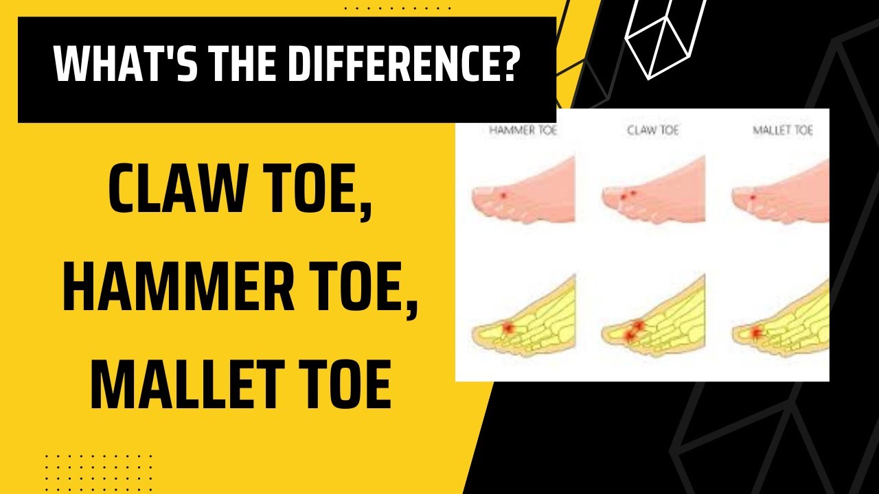 Do you know the difference? Claw toe, mallet toe, & hammer toe!