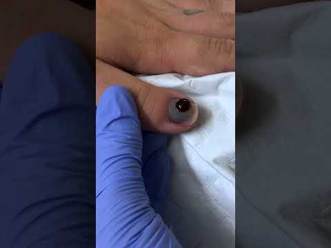 Trephination of a Fingernail Subungual Hematoma with Cautery