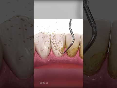 Scaling and Root Planing Therapy: AMSR
