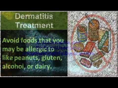 Watch irritant contact dermatitis treatment - Check Now!