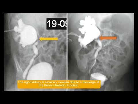 📌 CT Scan Findings Explained | Acute Pyelonephritis | PUJ Obstruction | Hydronephrosis | Kidney