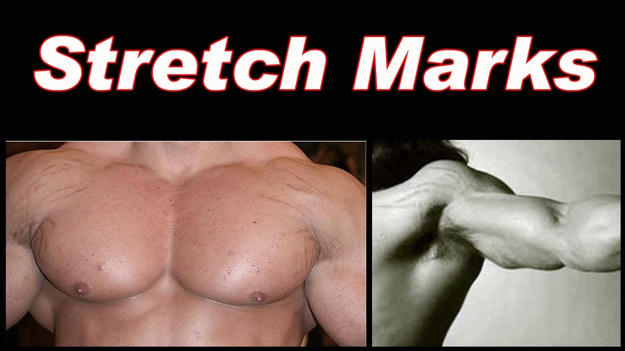 Bodybuilding Stretch Marks