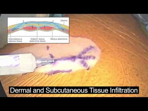 Dr. Weiss - Pfannenstiehl Incision Infiltration Video