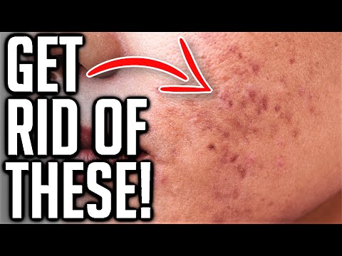 GET RID of Hyperpigmentation & Discoloration Spots FAST!