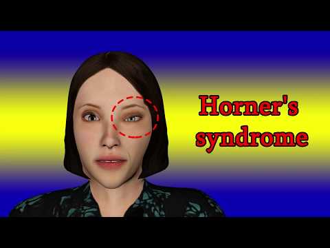 Horner's syndrome - Symptoms and causes