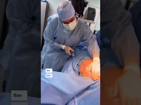 Generally during a Gynecomastia liposuction is performed to remove excess fat from the chest