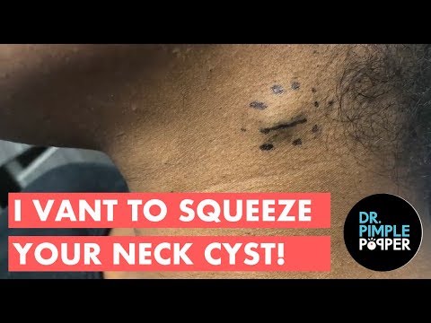 Dr. Pimple Popper Drains Patient's Huge Neck Cyst in New YouTube Video