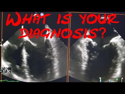 Cardiology Echo Quiz/Case: What is this structure on the Mitral Valve?
