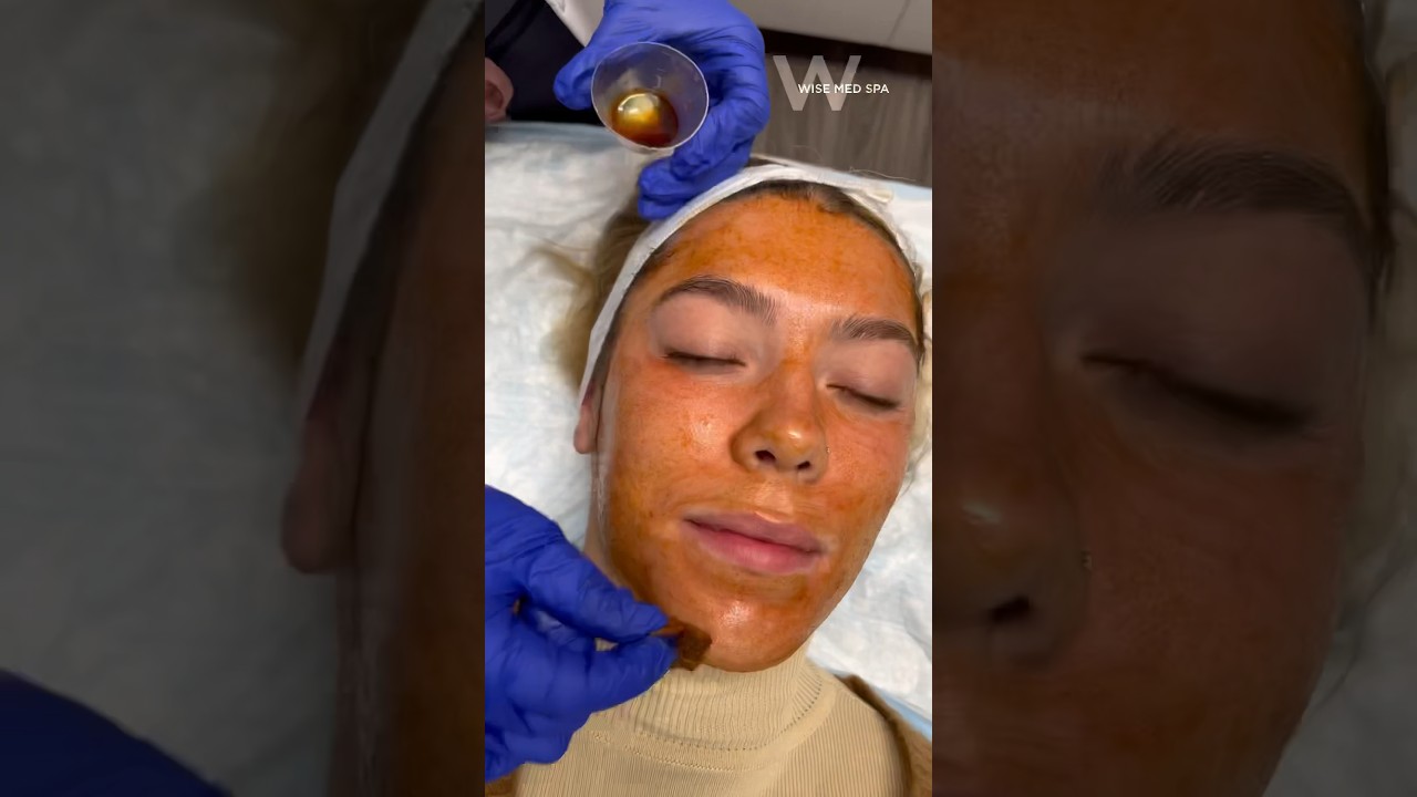 The VI Peel Purified Plus is used to minimize acne, scarring, and hyperpigmentation! #chemicalpeel