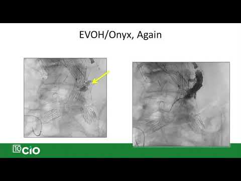Embolic Selection and Techniques in the Management of Endoleaks, Pulmonary AVMs and Aneurysms
