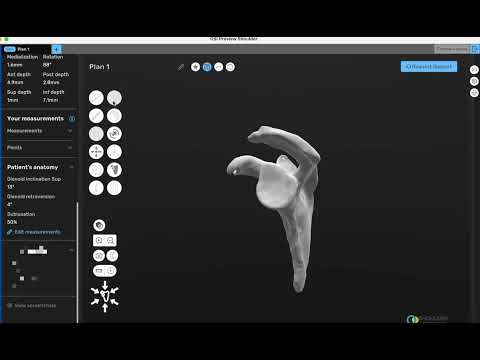 Planning a Reverse Shoulder Replacement with ProVoyance Software - Dr. Paul Kiritsis