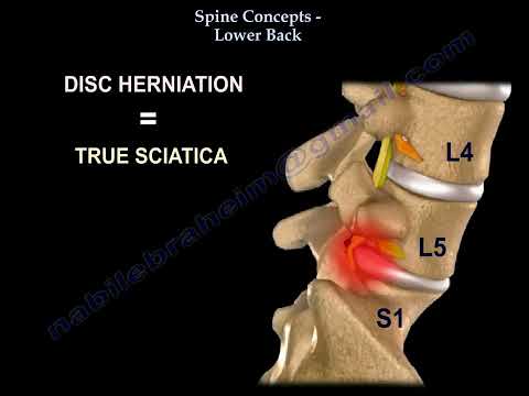 Sciatica and Lumbar Disc Herniation Causes Symptoms Diagnosis and ...