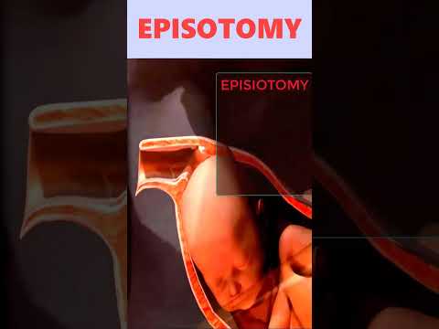 Episiotomy Surgical Incision π
π #shorts #labor