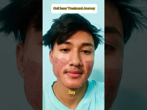 Co2 laser Treatment Journey || Acne Scar,Cut Mark Solution #laser #acnescars