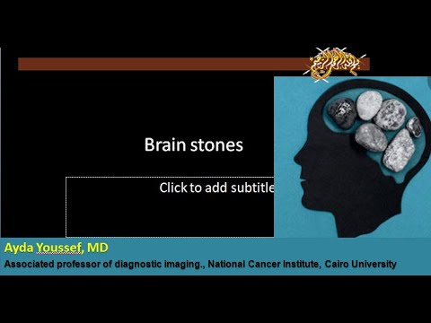 intracranial calcification