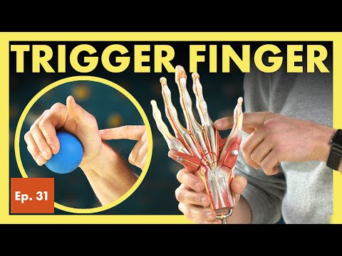 What is Trigger Finger and How Do I Fix It? (Stenosing Tenosynovitis)