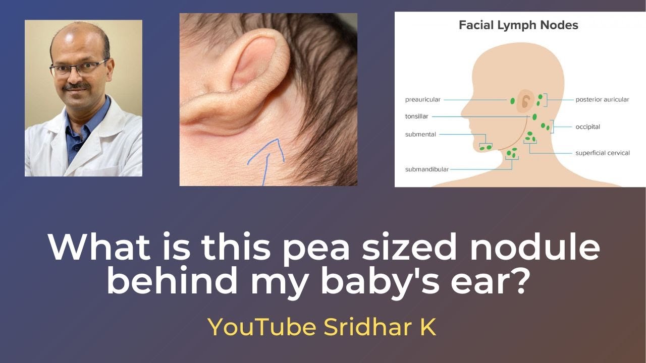 What is this pea like swelling behind my baby’s ears?  Sridhar K #lymphnode #nodule #babyswelling