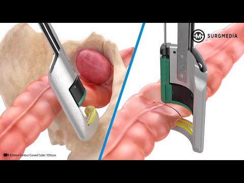 Multiple-Fire Surgical Curved Cutter Stapler: Focus On Complete Distal Transection