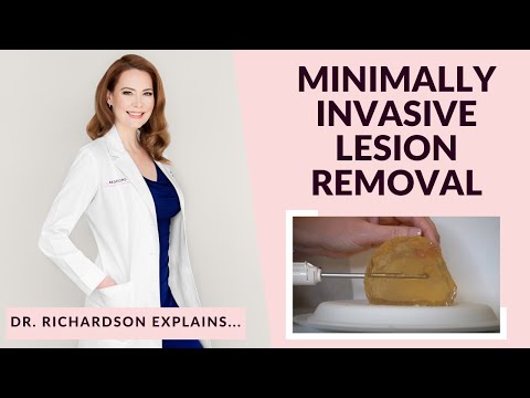Can We Remove A Benign Breast Lump Without Surgery? Yes. Dr. Richardson Explains!