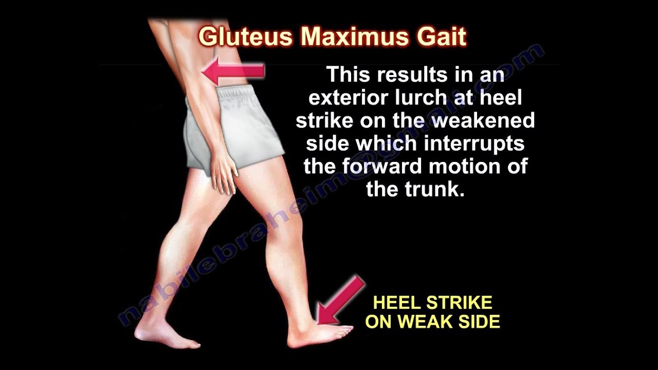 Gluteus Maximus Gait - Everything You Need To Know - Dr. Nabil Ebraheim
