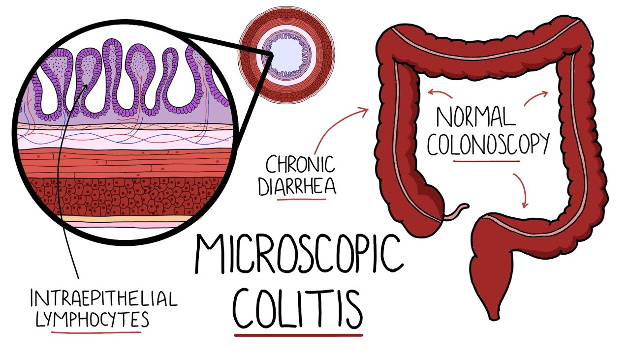 Microscopic Colitis (Lymphocytic & Collagenous Colitis) - An Underdiagnosed Form of IBD