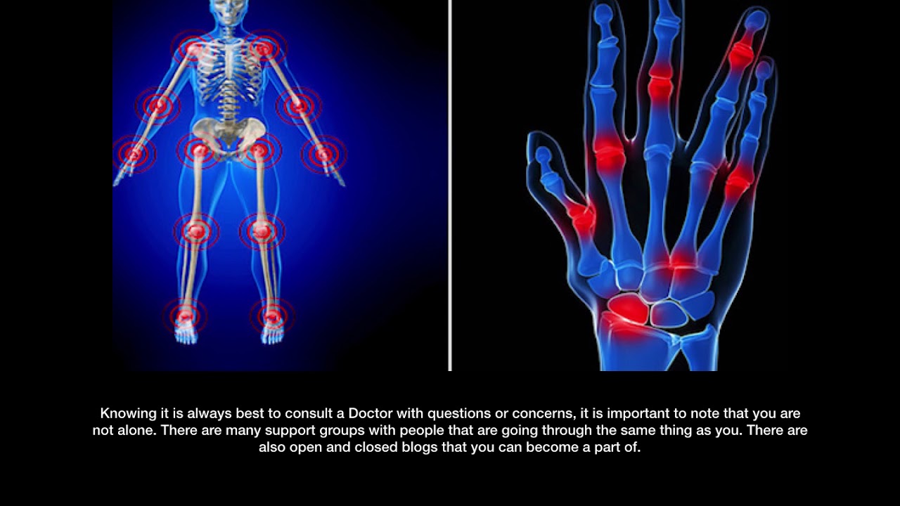 Arthritis power point