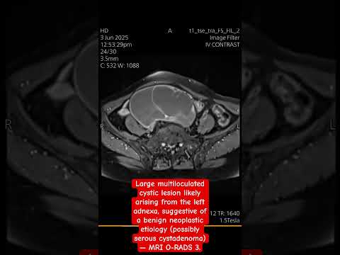 (possibly serous cystadenoma) #radiology #uterus #mri #mritech #radiologystudent #clinicalradiology