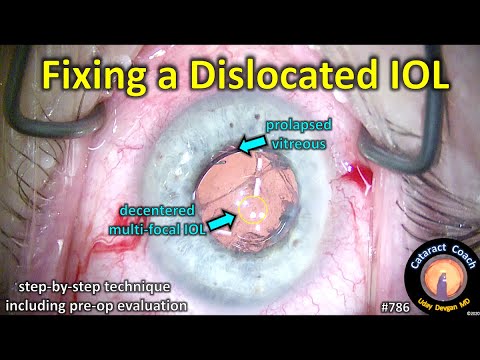 fixing a dislocated IOL (tecnis multifocal IOL)