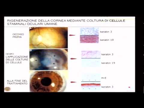 Holoclar: un farmaco a base di staminali per i danni alla cornea ...