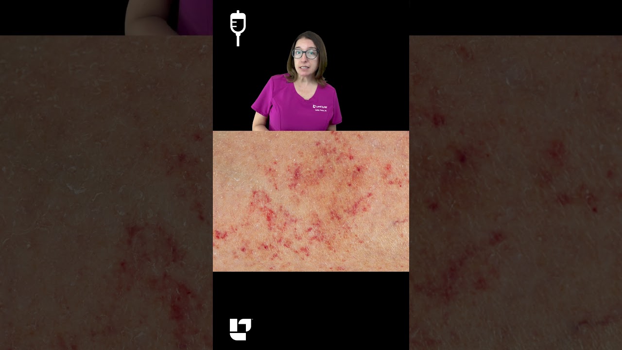 👩🏻🩺Cathy explains what petechiae are, and causes of petechiae: Medical Surgical SHORT | @LevelUpRN