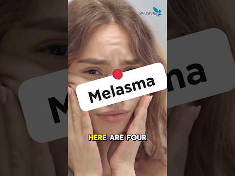 What is Melasma? #facials #melasma