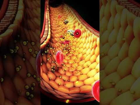 Treating Heart Disease - Part 2 - Arteriosclerosis