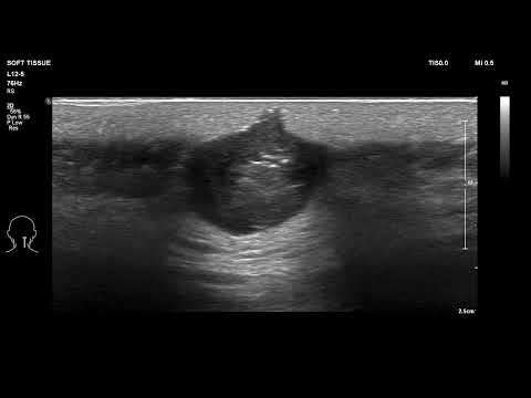 epidermal inclusion cyst