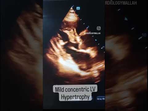 Mild concentric LV hypertrophy Echocardiography #echocardiography #cardiology #cardiologia